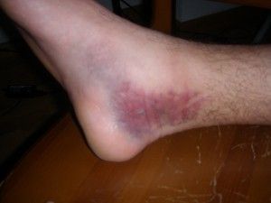 Equimosis - Farmaconsejos