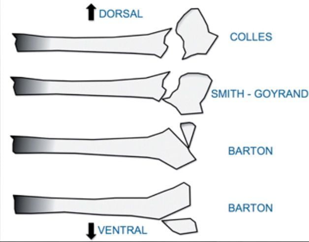 Clasificación De Las Fracturas De Colles